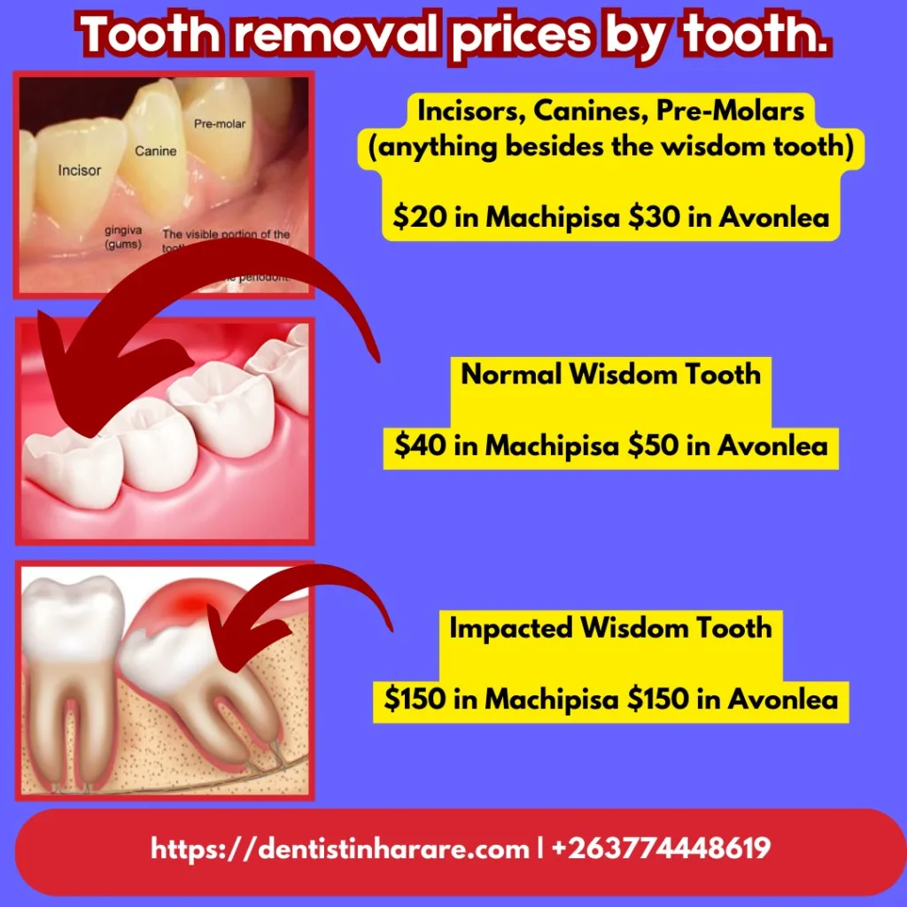 How Much Does a Tooth Extraction Cost in Harare? - Find a Dentist in Harare